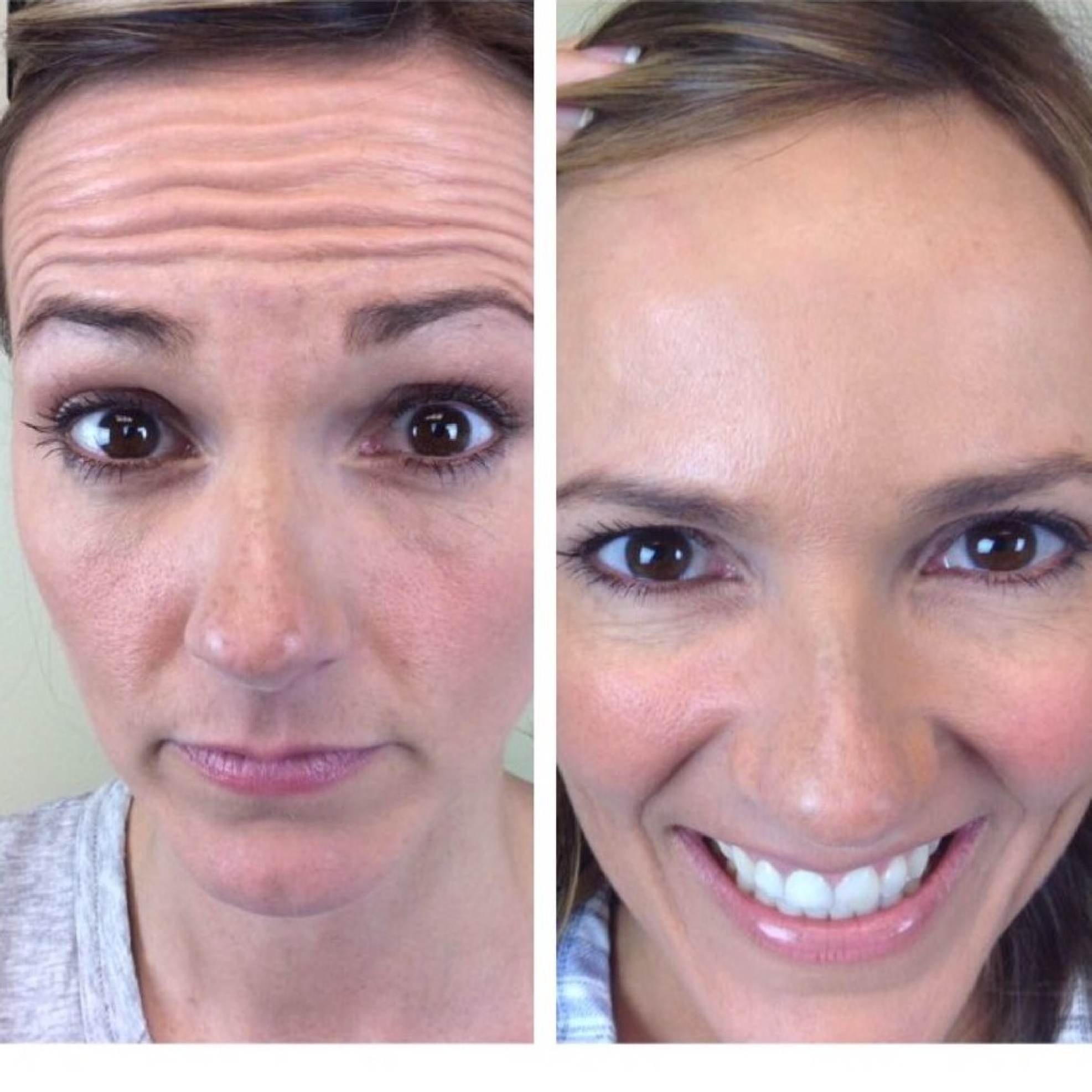 Botox in Guildford - First Aesthetics